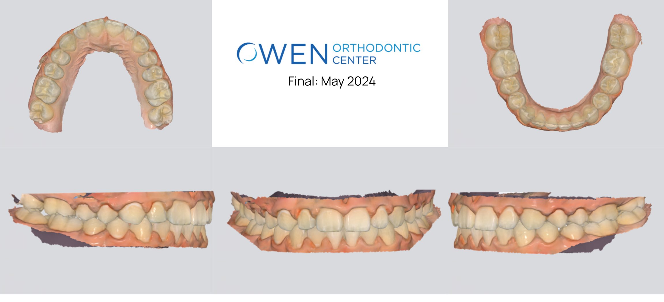 Custom Metal Twin Case Study - Dr. Brandon Owen