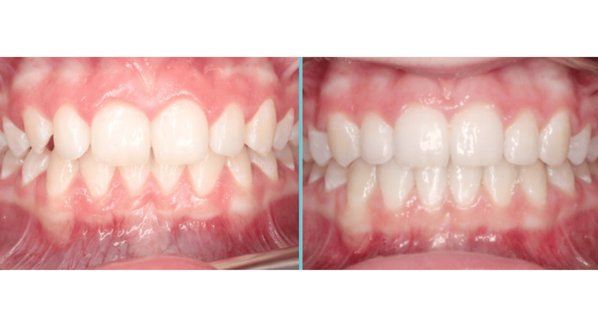 Custom Metal Twin Case Study - Dr. Kristen Knecht