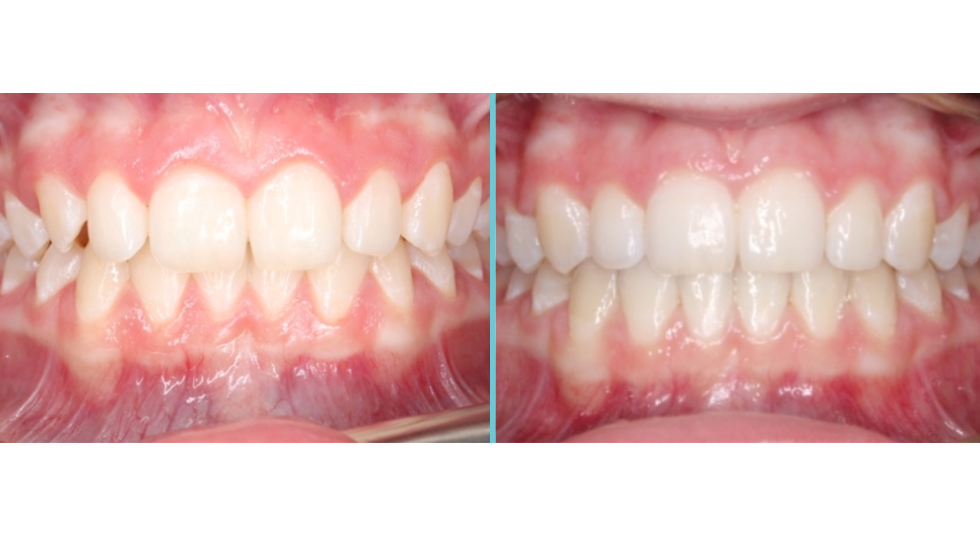 Custom Metal Twin Case Study - Dr. Kristen Knecht